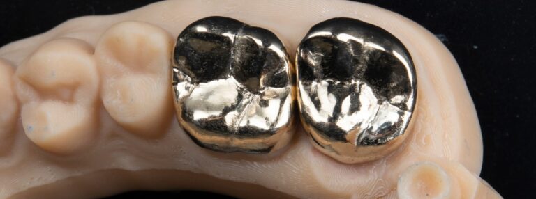 Precious metal restorations - HT Dental ART