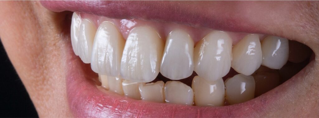 Mặt dán sứ màu tự nhiên - HT Dental ART