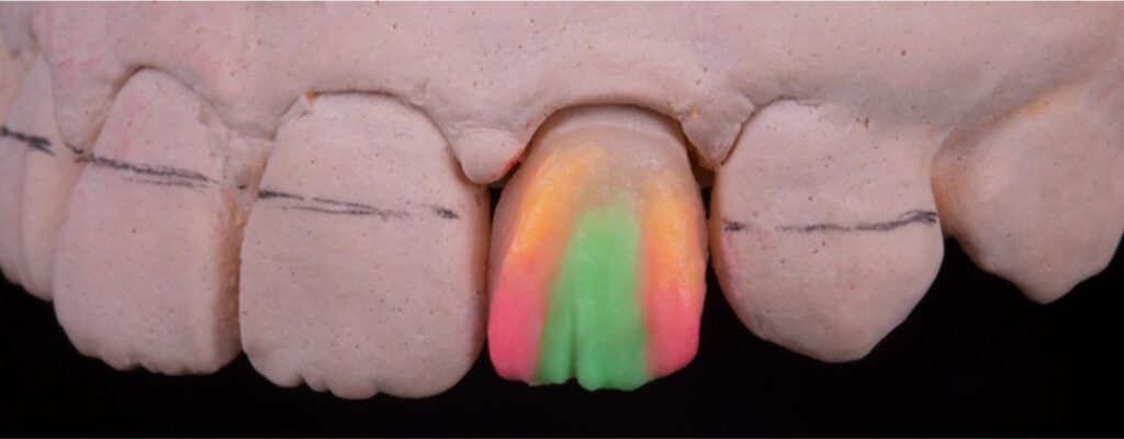 Single esthetic veneers - HT Dental ART