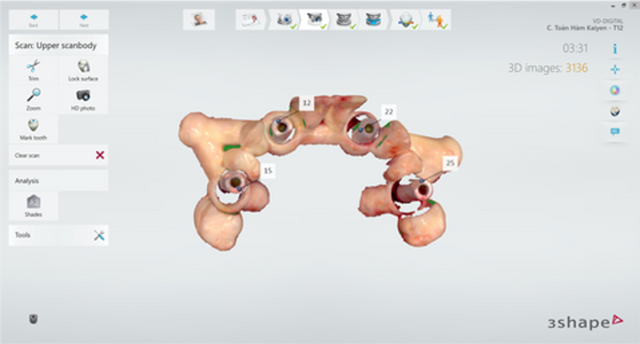 QUY TRÌNH PHỤC HÌNH TOÀN HÀM TRÊN IMPLANT - HT Dental ART