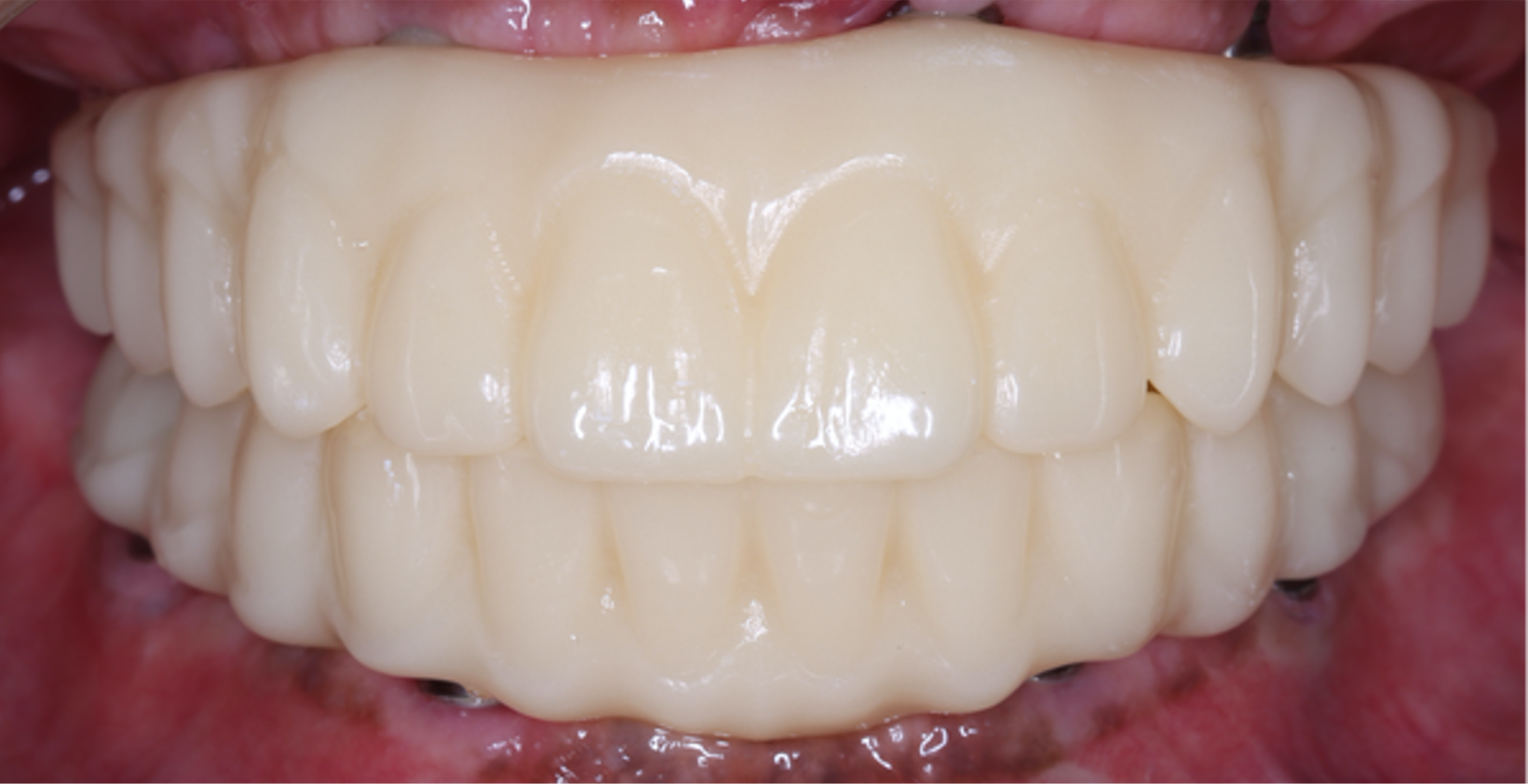 QUY TRÌNH PHỤC HÌNH TOÀN HÀM TRÊN IMPLANT - HT Dental ART
