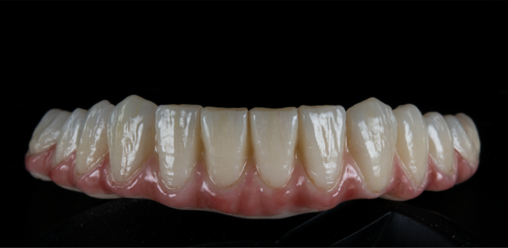 QUY TRÌNH PHỤC HÌNH TOÀN HÀM TRÊN IMPLANT - HT Dental ART
