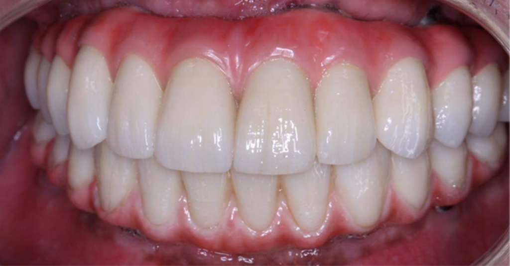 QUY TRÌNH PHỤC HÌNH TOÀN HÀM TRÊN IMPLANT - HT Dental ART