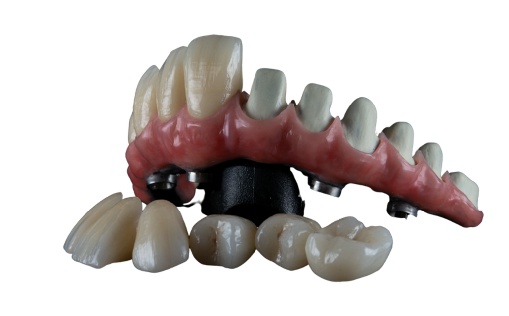 Full-arch Implant-Supported Restoration - HT Dental ART