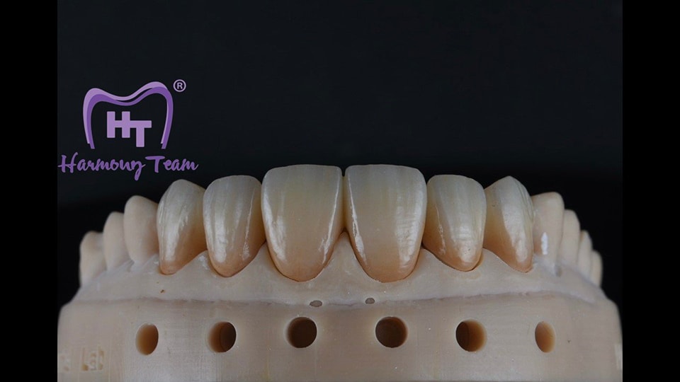 WORKFLOW OF FABRICATING ALL-CERAMIC ZIRCONIA RESTORATIONS (ZIRCAD, LAVA ...